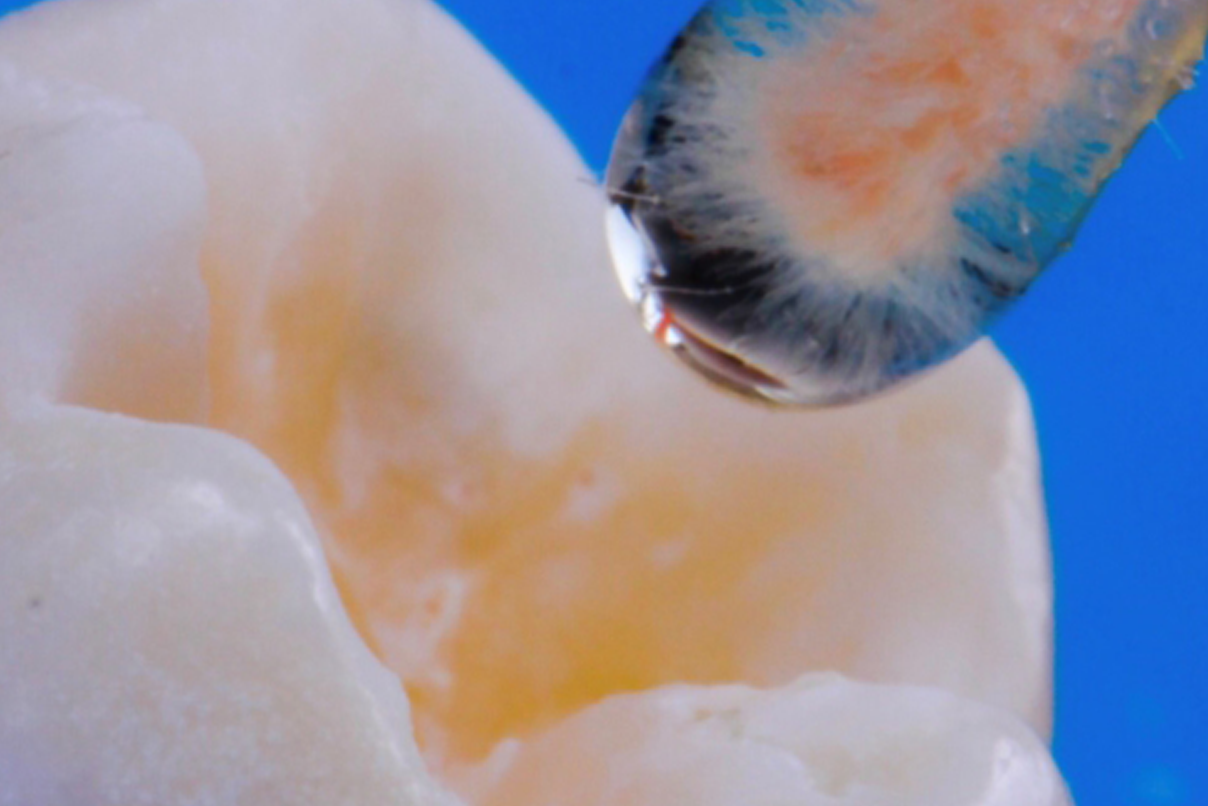 Dentala adhesivers biologiska effekter | Klinik & Ventenskap | Dental24